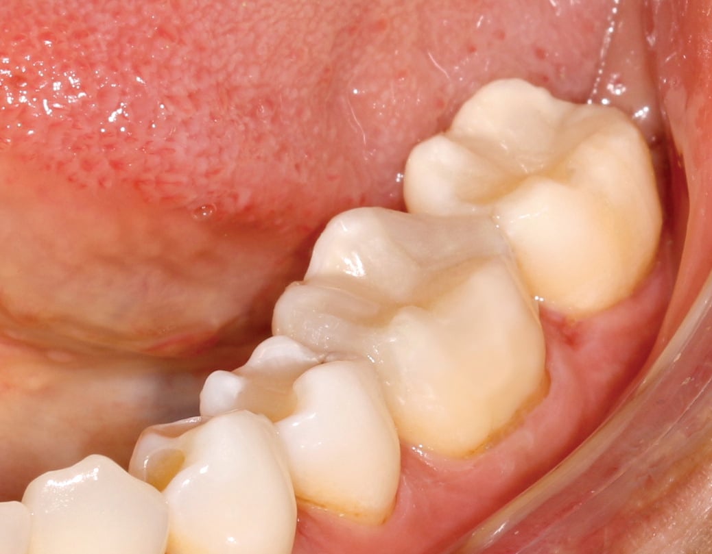 Clinical Guide: Transcend Composite